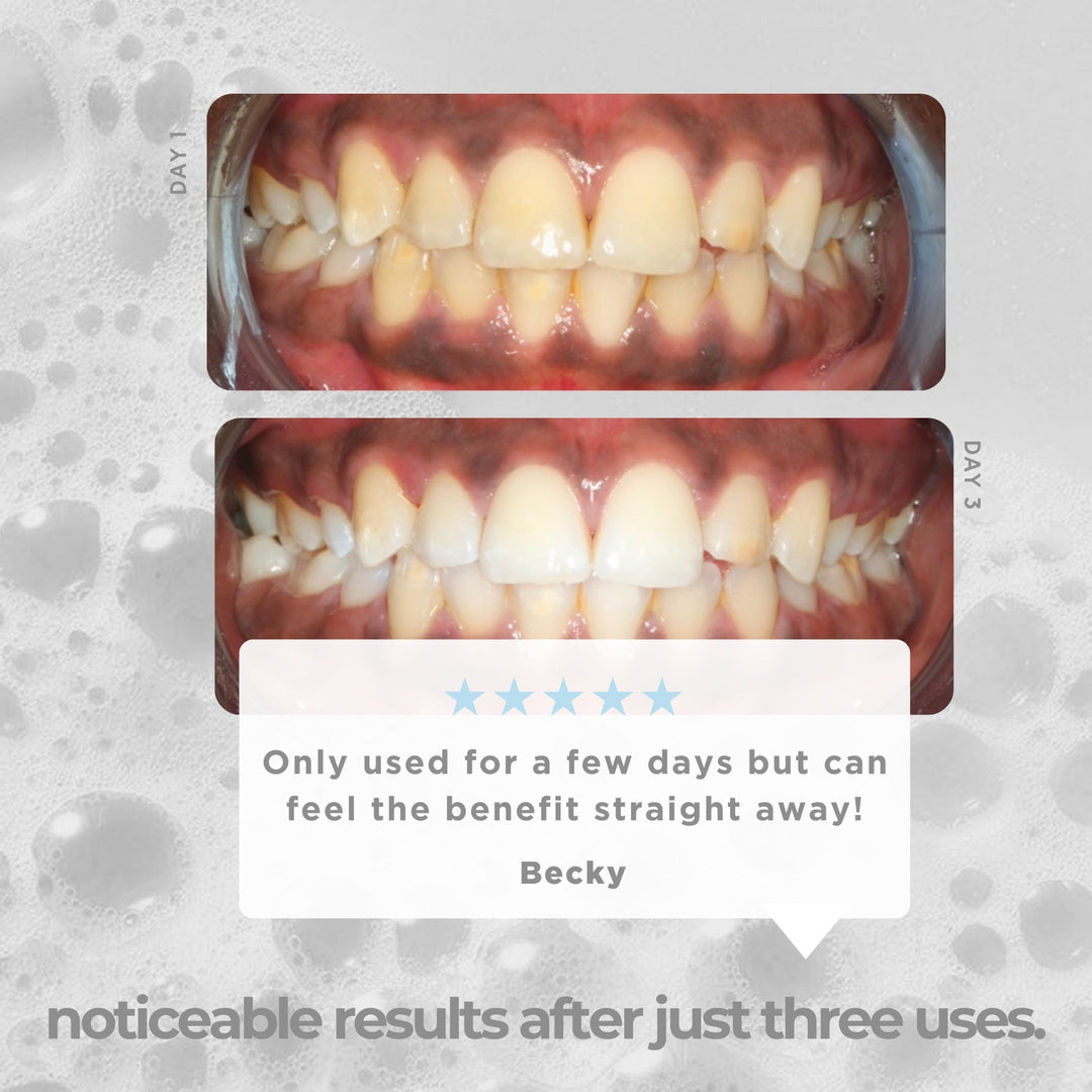 Teeth Whitening Kit – Icy Bear Dental