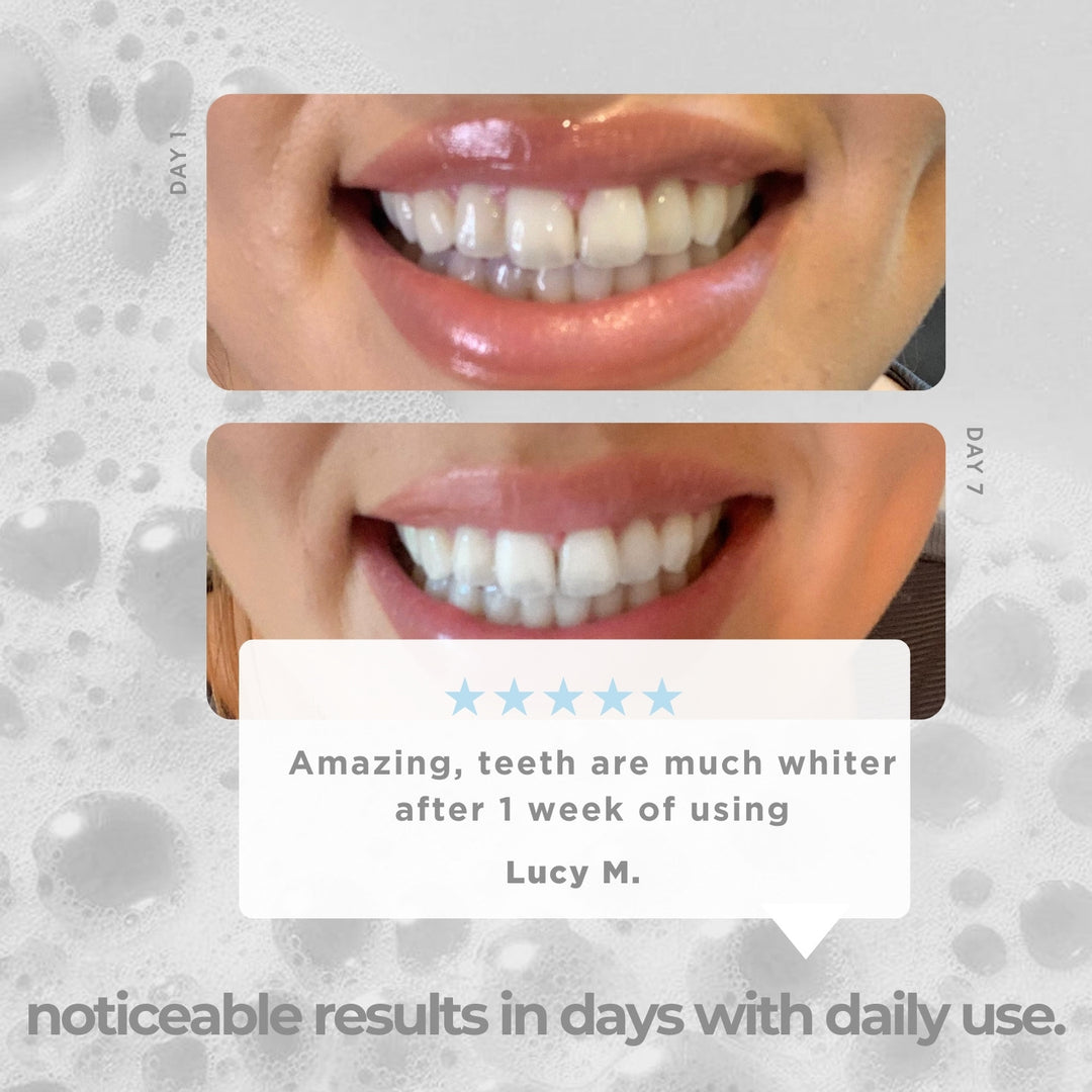 Shop Teeth Whitening Powder - Best Tooth Stain Removal – Icy Bear Dental